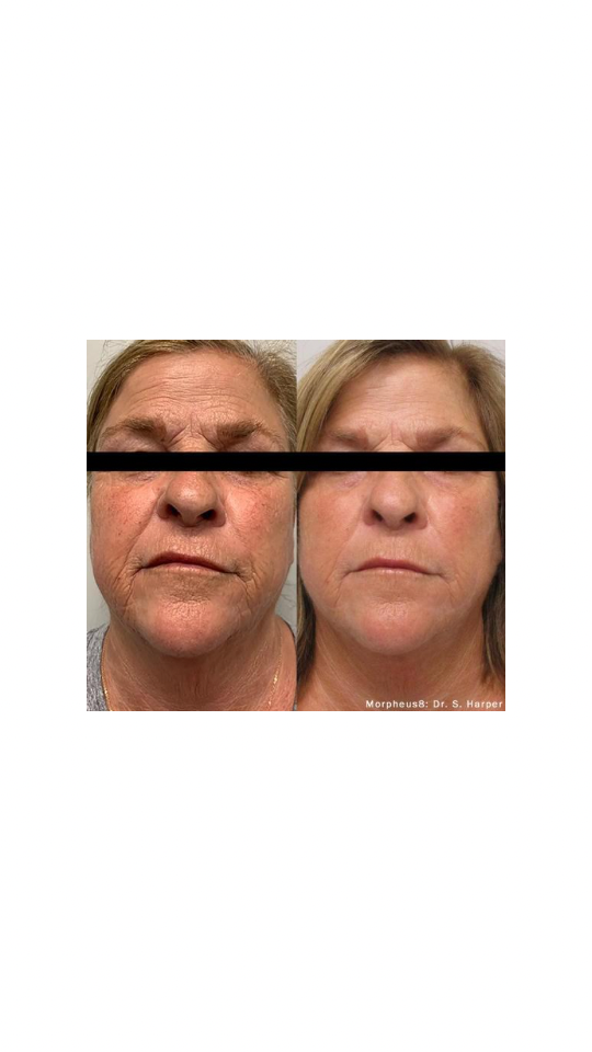 Morpheus8 | Metamorphosis Holistic MedSpa