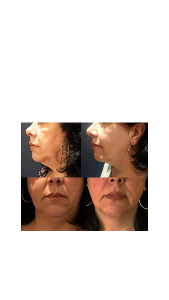 Morpheus8 | Metamorphosis Holistic MedSpa