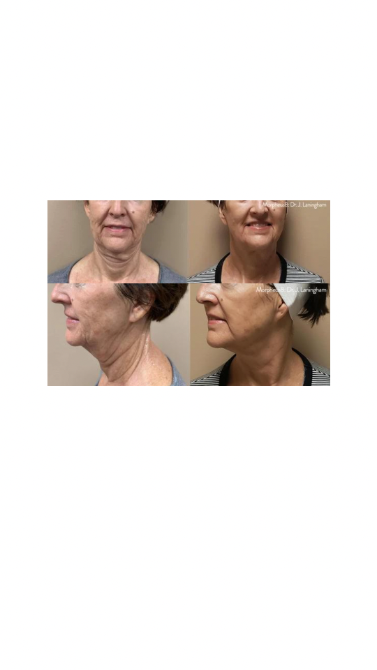 Morpheus8 | Metamorphosis Holistic MedSpa