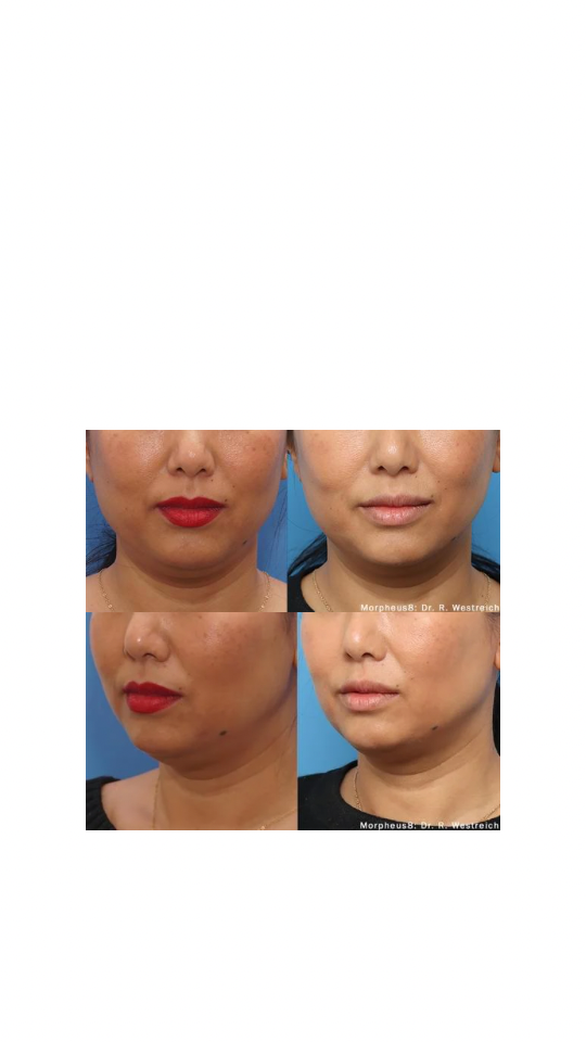 Morpheus8 | Metamorphosis Holistic MedSpa