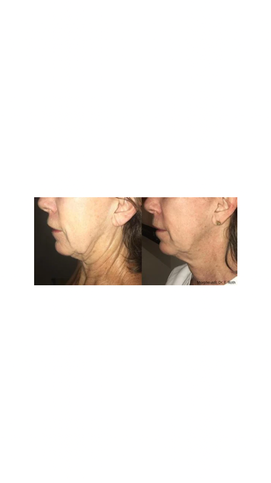 Morpheus8 | Metamorphosis Holistic MedSpa