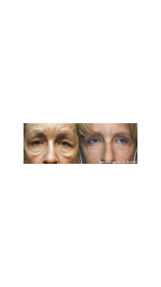 Morpheus8 | Metamorphosis Holistic MedSpa