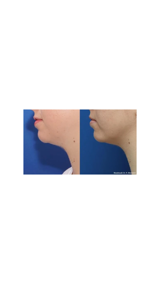 Morpheus8 | Metamorphosis Holistic MedSpa