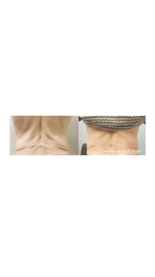 Morpheus8 | Metamorphosis Holistic MedSpa