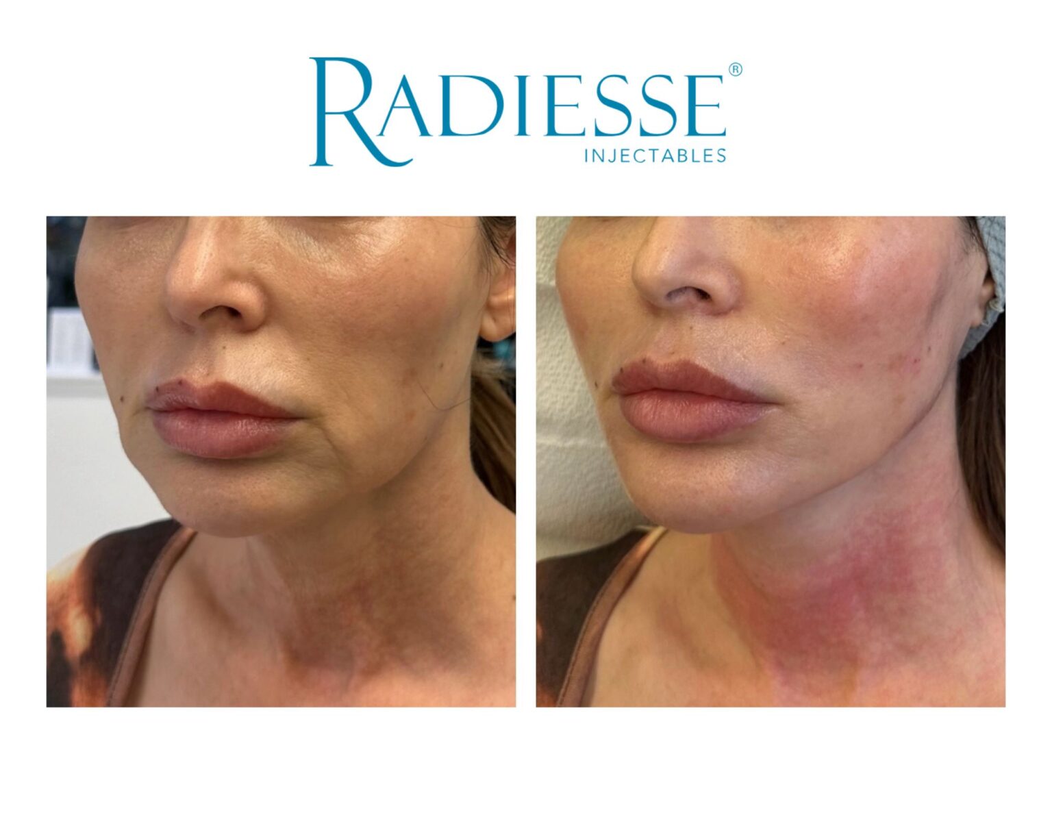 Hyperdilute Radiesse - Metamorphosis Holistic MedSpa, PLLC