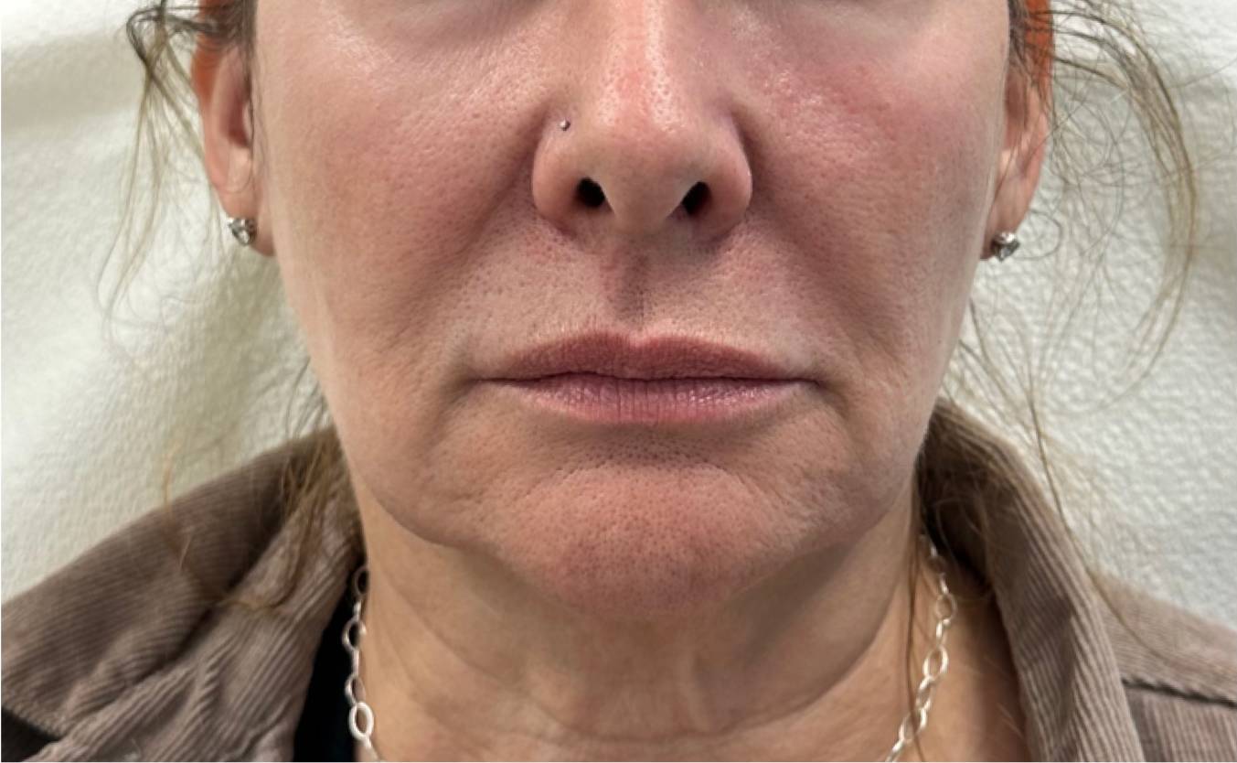Forma RF Skin Tightening Bellevue & Issaquah WA